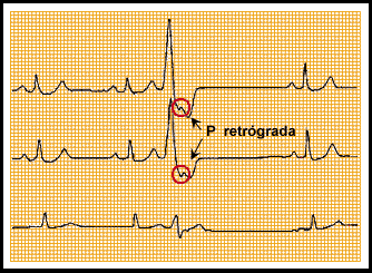 Dr. Rafael Soto - Electrocardiografía - Cardiología clínica: Onda P ...