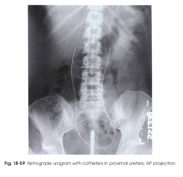 azizah nur: Retrograde Pyelography