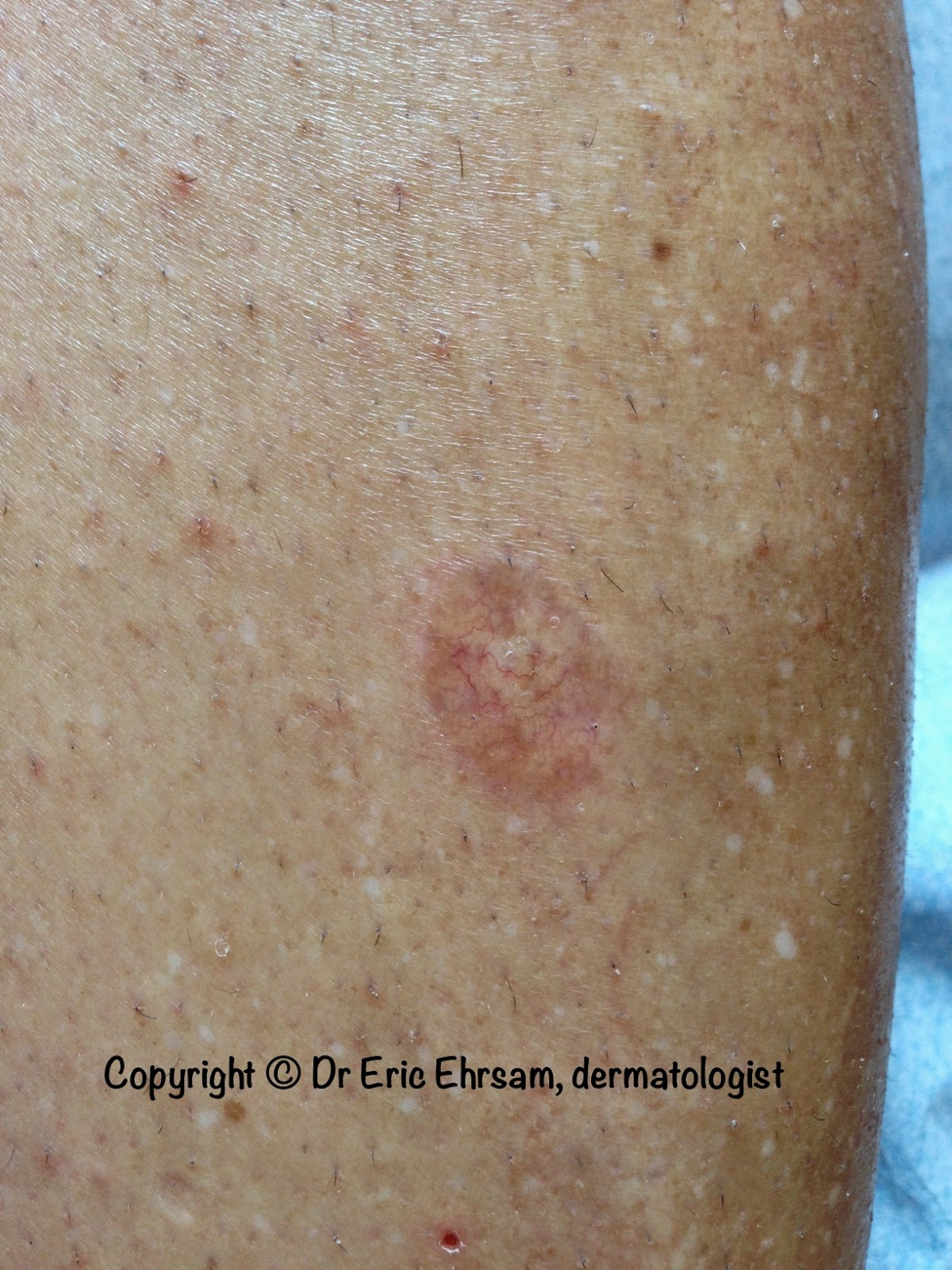dermoscopy: Macular lesion on a leg.