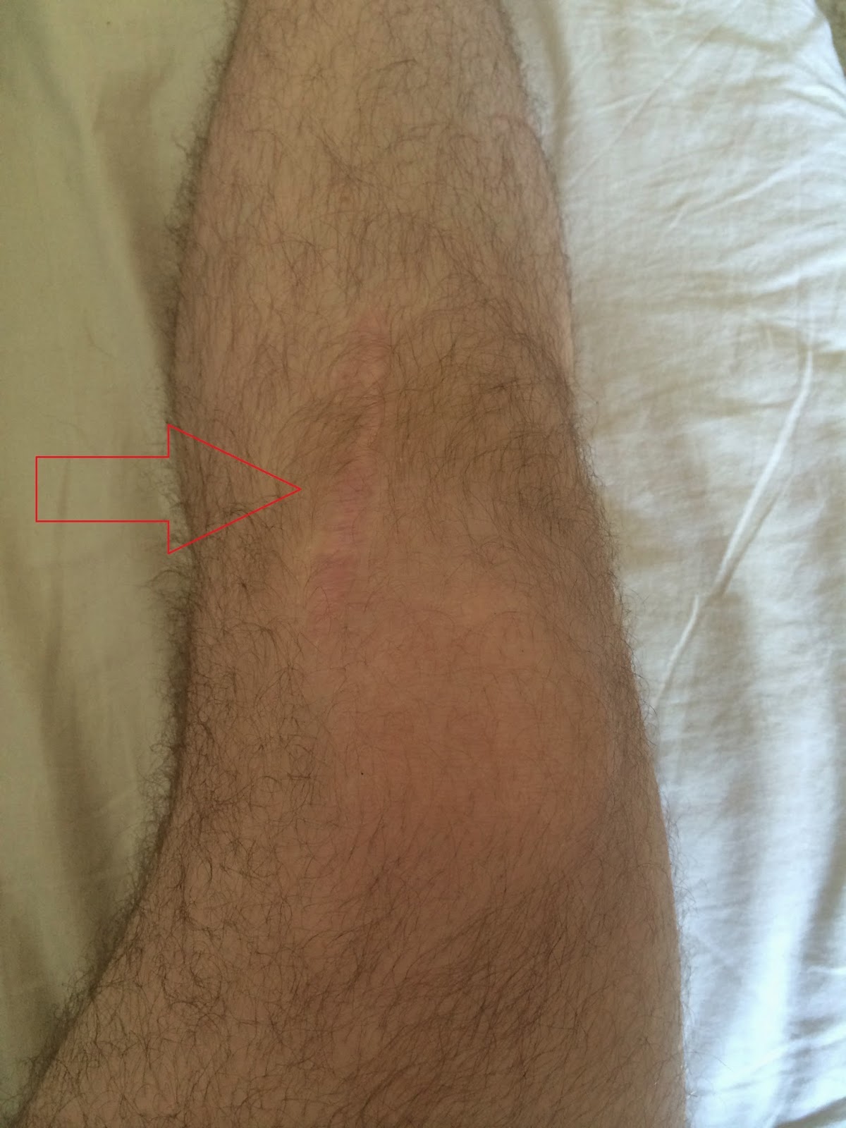 Elmslie-trillat operation (2 års tillbakablick) | Österbottningen