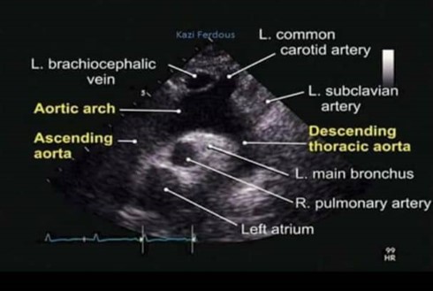 CVT Mohd Farid: Basic Echocardiography:Transthoracic Echocardiography ...