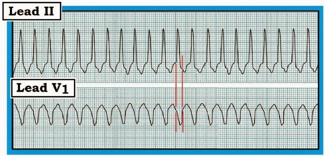ECG Interpretation: ECG Interpretation Review #39 (Narrow-QRS ...