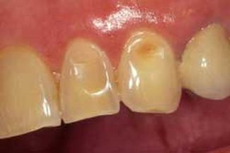 Erosión dental: causas y tratamientos (Odontología)