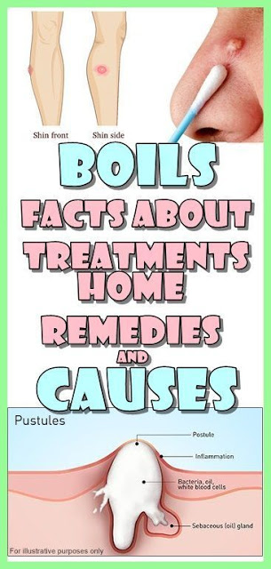 BOILS: Facts About Treatments, Home REMEDIES & CAUSES ~ Natural Cures House