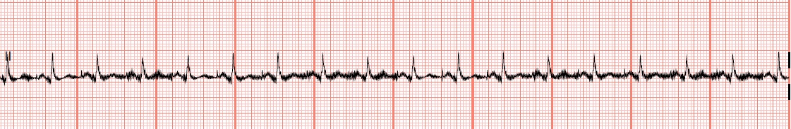Float Nurse: EKG Rhythm Strips 65