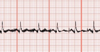 Float Nurse: EKG Rhythm Strips 65