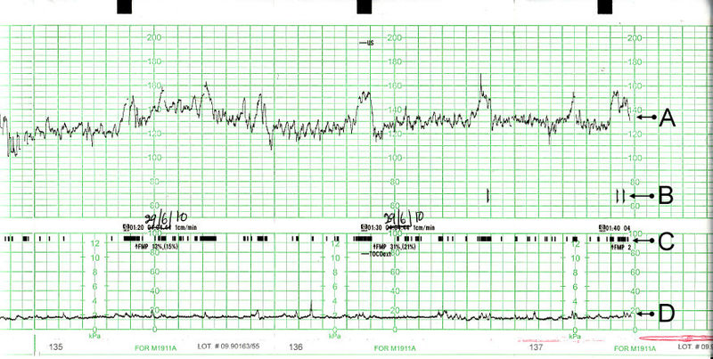 CARDIOTOGRAPH (CTG) untuk Pemeriksaan Kesehatan Janin | Biomedical ...