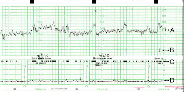 CARDIOTOGRAPH (CTG) untuk Pemeriksaan Kesehatan Janin | Biomedical ...