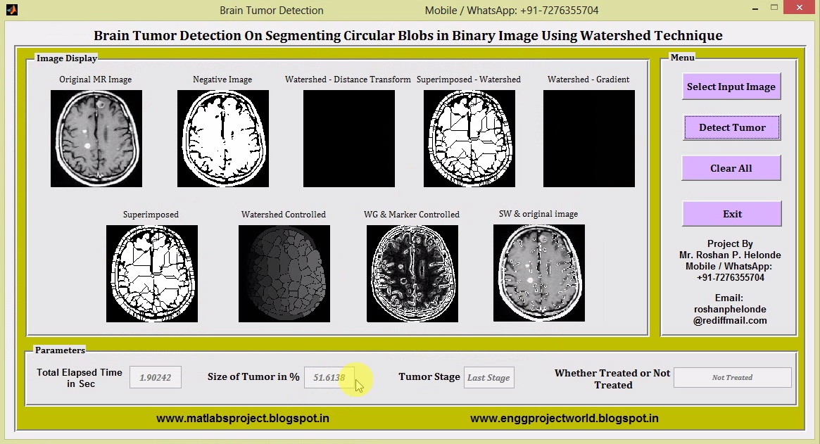 Brain Tumor Detection Using Watershed Technique Matlab Project With Source Code Ieee Based
