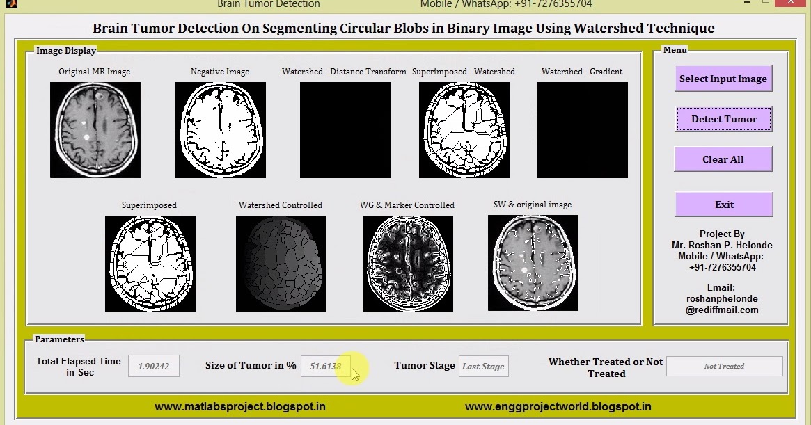 Brain Tumor Detection Using Watershed Technique Matlab Project With Source Code Ieee Based