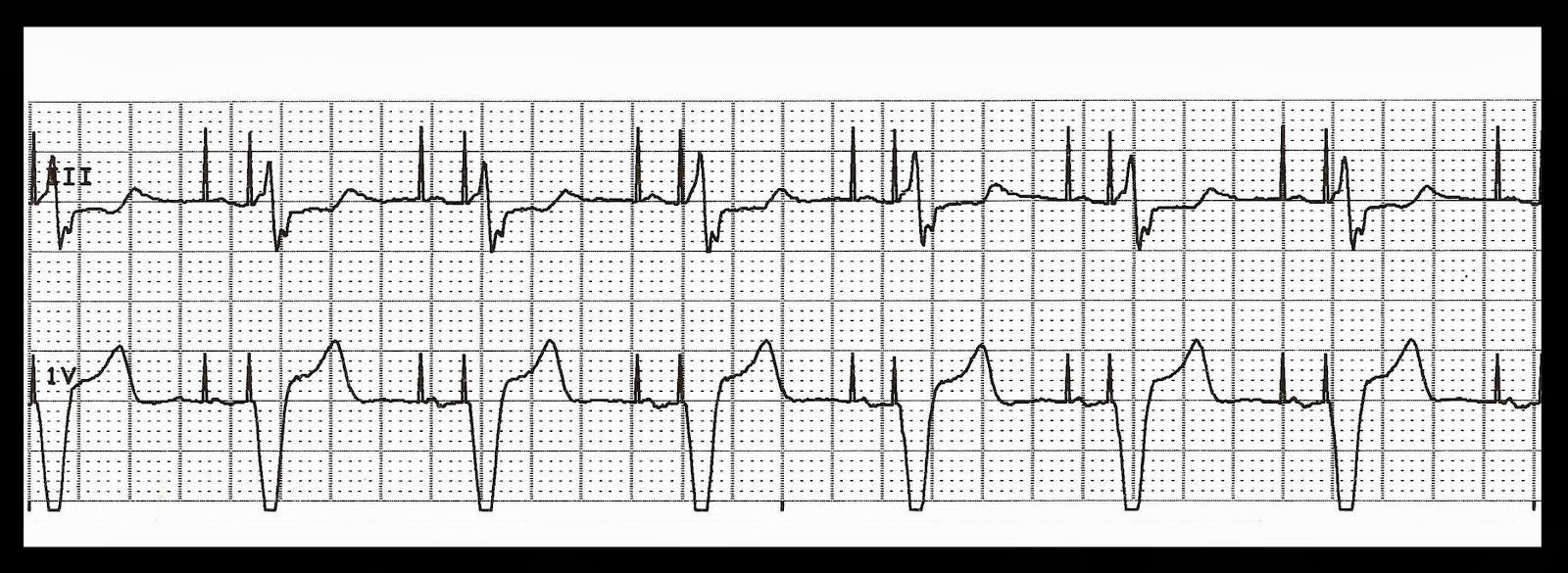 EKG Rhythm Quiz 253