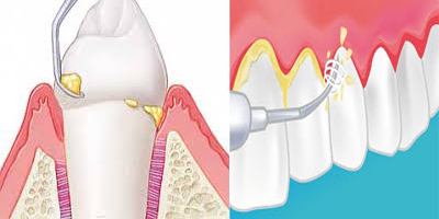 Limpieza dental con raspado - Limpieza Dental Soluciones Caseras