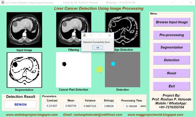 Liver Cancer Detection Using Image Processing Matlab Project Source ...