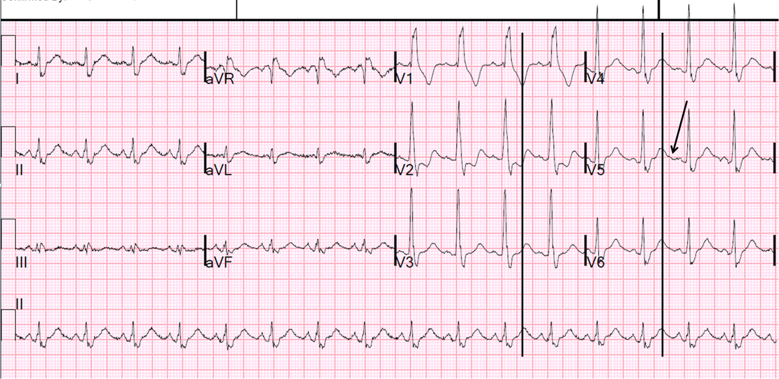 Dr. Smith's ECG Blog: Right Bundle Branch Block with Biphasic Wave in ...