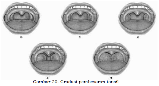 144 PENYAKIT: TONSILITIS