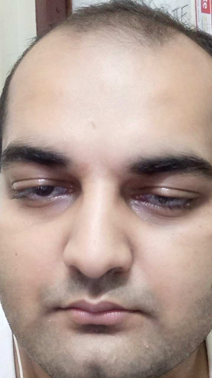 Dentosphere : World of Dentistry: # I.V. Diazepam in a patient on a ...