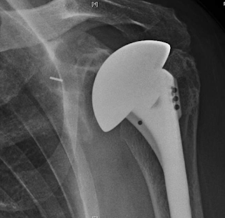 UW Shoulder and Elbow Academy: B2 retroverted glenoid => total shoulder ...