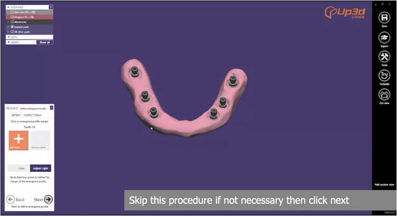 Dental CAD/CAM system: Implant Bridge design by exocad
