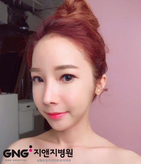 GNG Plastic Surgery Hospital: What is Endotine Forehead Lift?