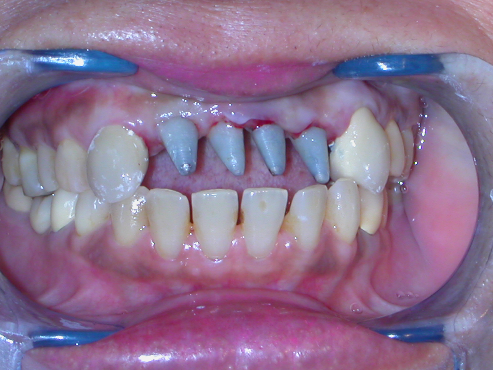 Dental Implantology: MISSING UPPER FRONT TEETH: GRAFT FREE TREATMENT OF ...