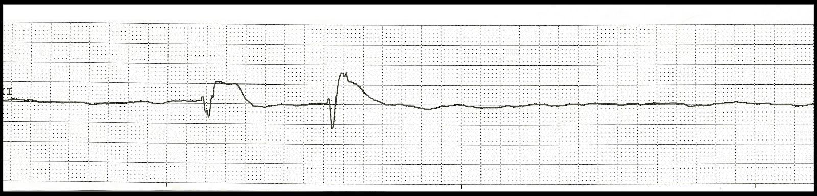 EKG Rhythm Strips 91 Various Agonal Rhythms