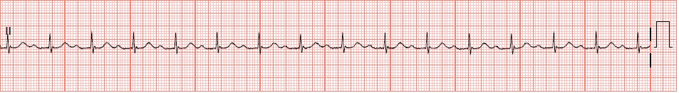 EKG Rhythm Strip Quiz 52: Heart Blocks