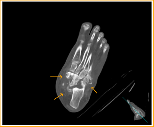 Neuropathic Joint (Charcot Joint) - Sumer's Radiology Blog