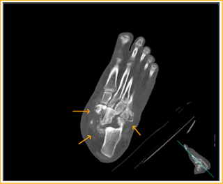 Neuropathic Joint (Charcot Joint) - Sumer's Radiology Blog