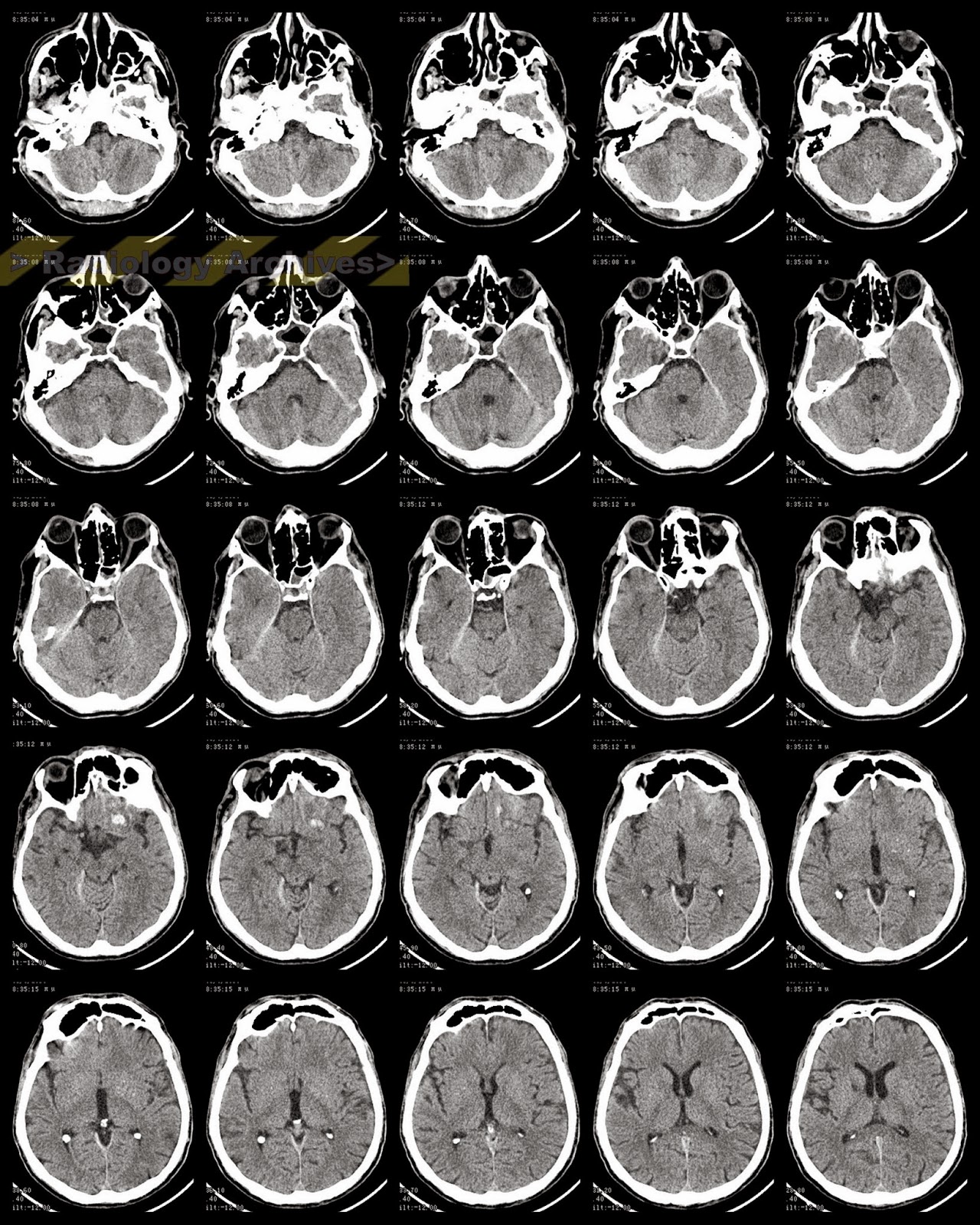 Radiology Archives: Κρανιοεγκεφαλική Κάκωση (Κ.Ε.Κ.)