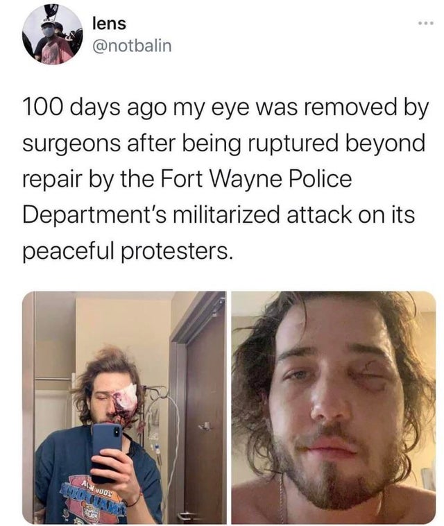 Want a bad ass eye patch? Protest Peacefully! (Picture) - STATIONGOSSIP