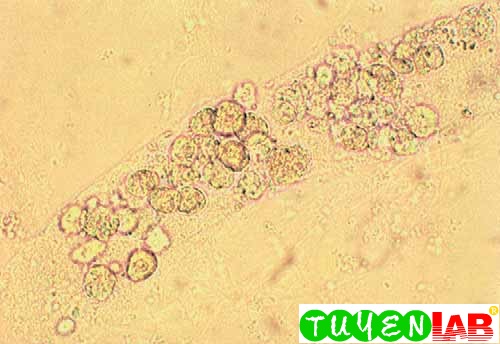 Atlas of Casts in urine | Free Medical Atlas