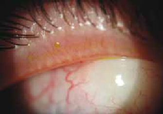 Dzień dobry dla oczu: Dysfunkcja gruczołów Meiboma. Zapalenie brzegów ...