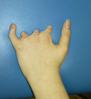 Toe Transfers | Congenital Hand and Arm Differences | Washington ...