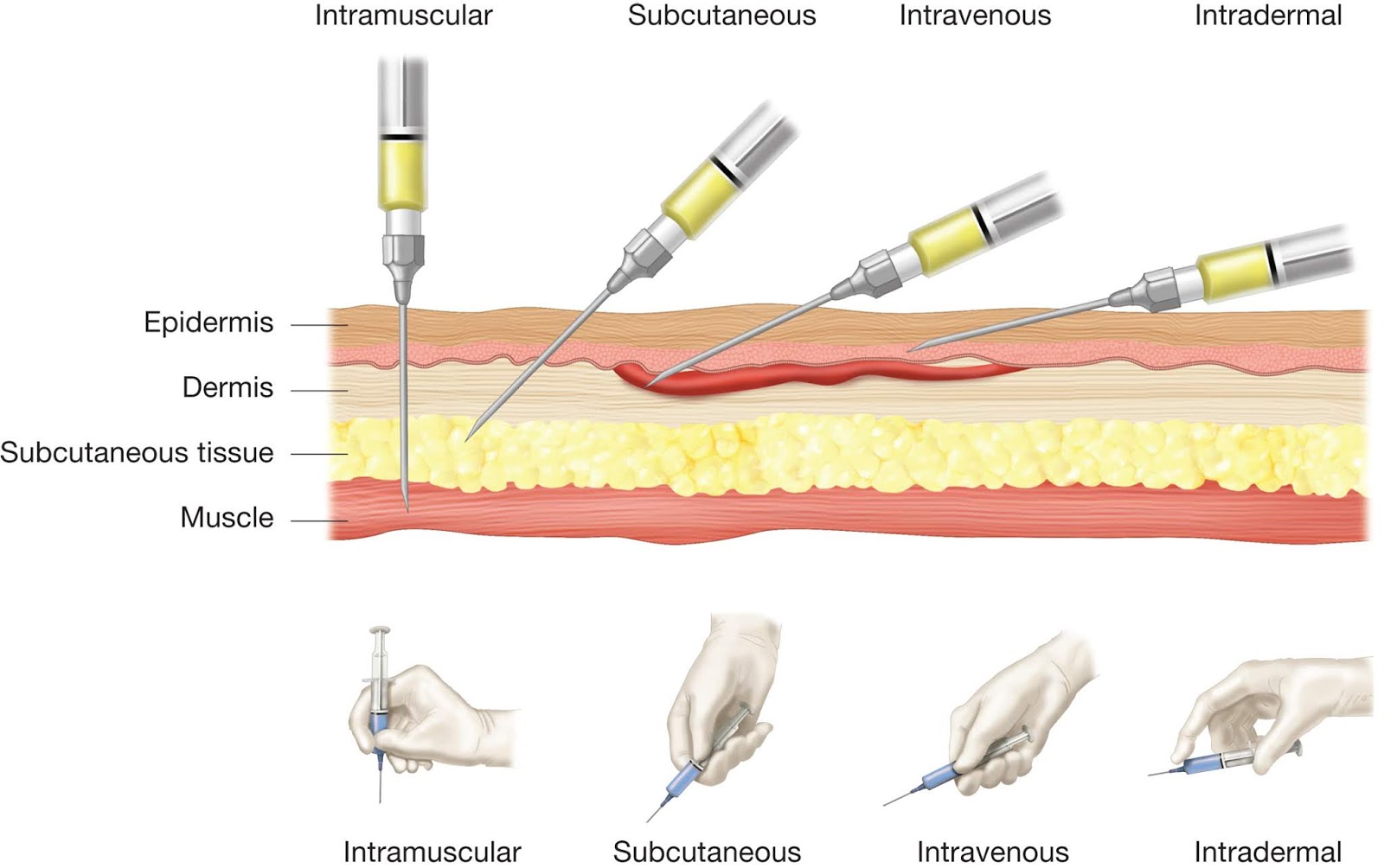 Administration of Injectable Medications - Medical Yukti