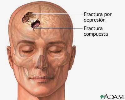 ESPE 202 - 2014: TEC y rasgos de fractura de cráneo en radiografía.