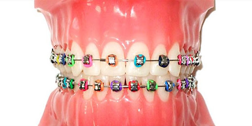 ORTODONCIA : ¿Para qué sirve la cadena de poder? - OdontoVida