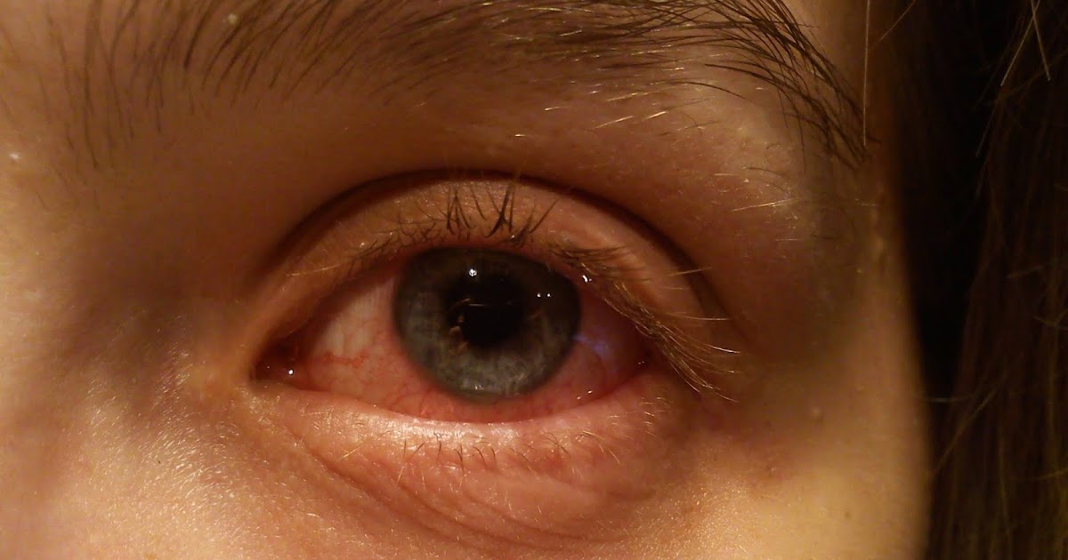 𝖑𝖊𝖙𝖘 𝖕𝖗𝖔𝖋𝖎𝖈𝖎𝖊𝖓𝖙: What is Black Fungus. How it spreads. Precautions ...