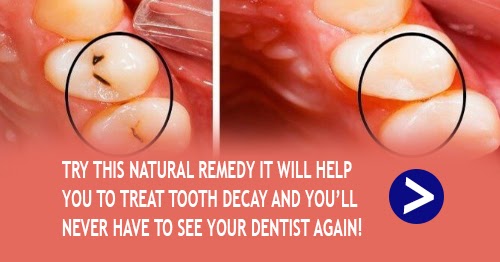 TRY THIS NATURAL REMEDY IT WILL HELP YOU TO TREAT TOOTH DECAY AND YOU ...