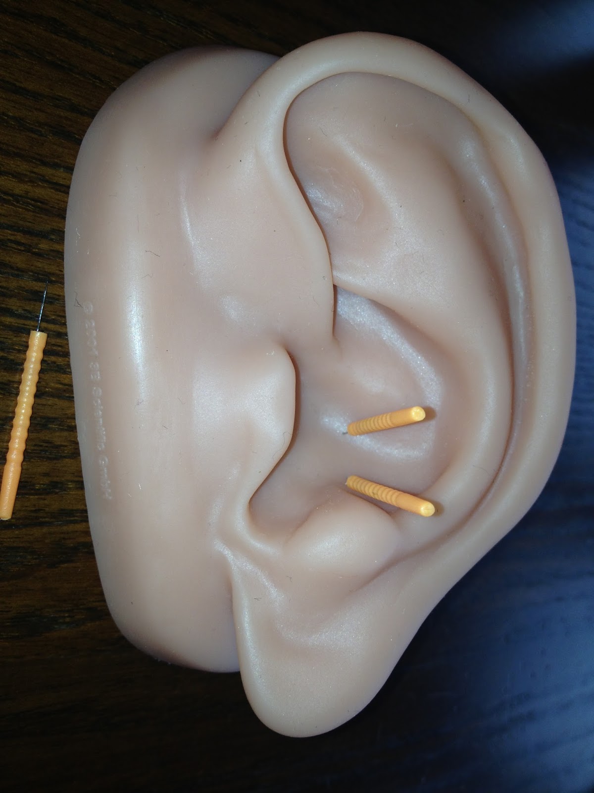 Auricular Acupuncture