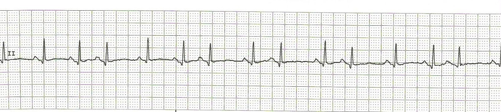 EKG Rhythm Strip Quiz 62