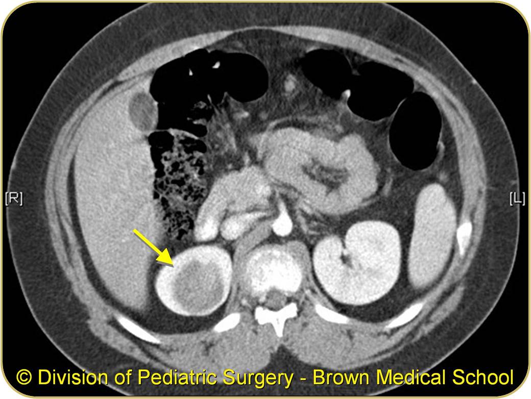Radiologist For Ever: Renal rule 5 : Renal solid lesions