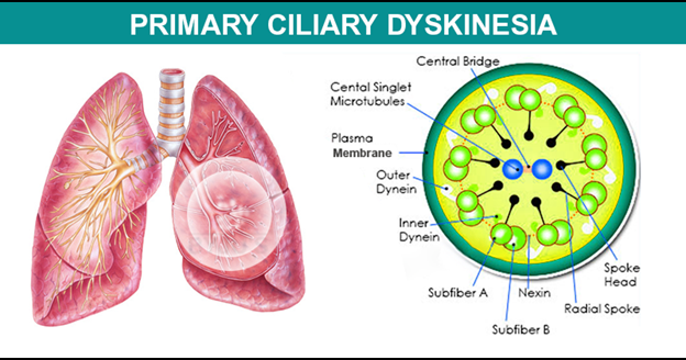 Ayurvedic Treatment for PCD (Primary Ciliary Dyskinesia) - Symptoms ...