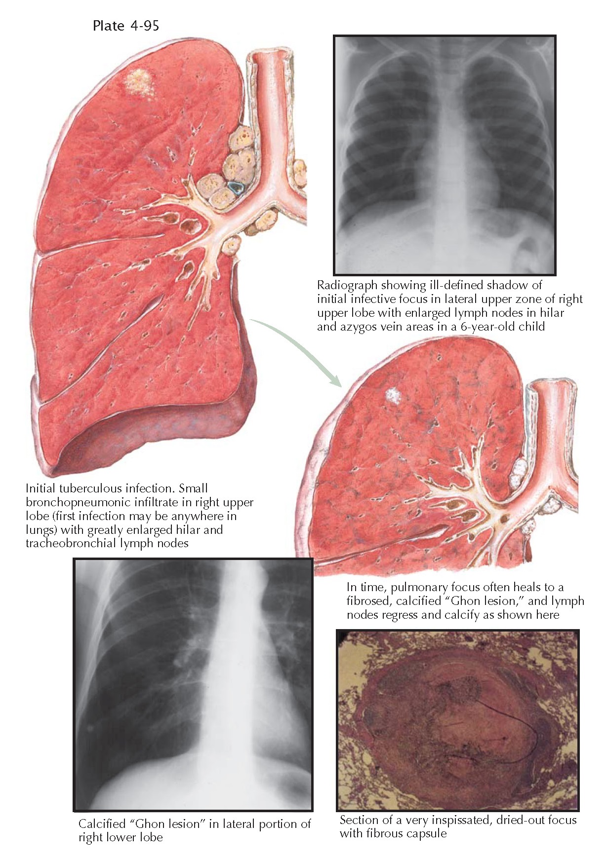 TUBERCULOSIS - pediagenosis