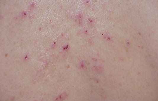 Symptoms gluten intolerance skin rash