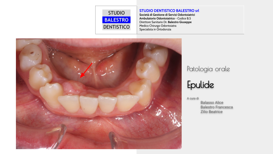 Studio Dentistico Balestro: Epulide
