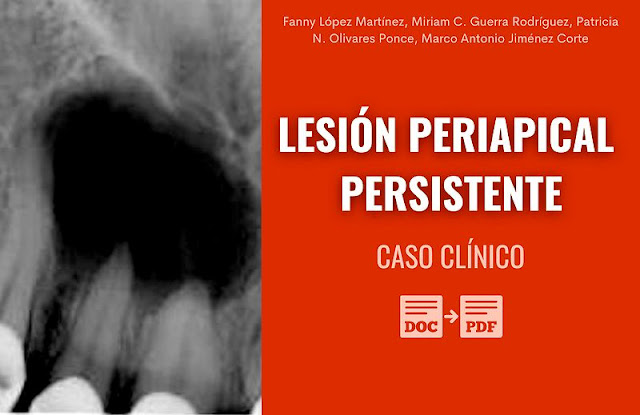 PDF: Lesión periapical persistente: caso clínico
