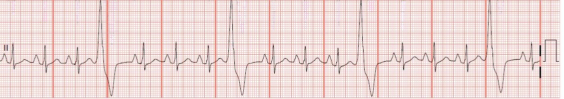 EKG Rhythm Strip Quiz 18