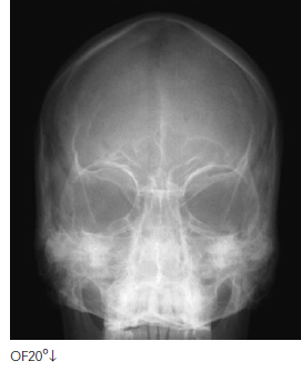 Medical Imaging Technology: Skull Radiography- Lateral and PA views