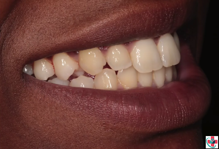 Common reasons for teeth discoloration and what to do