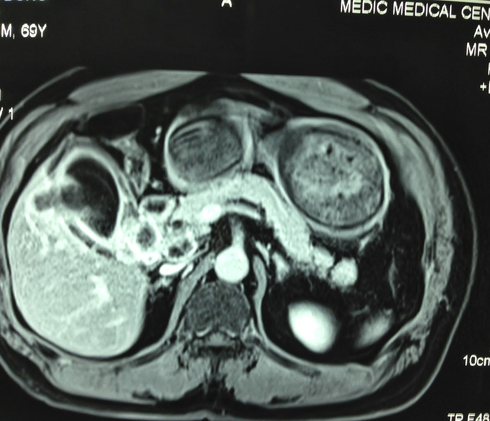 VIETNAMESE MEDIC ULTRASOUND: CASE 243: GALLBLADDER TUMOR, Dr PHAN THANH ...